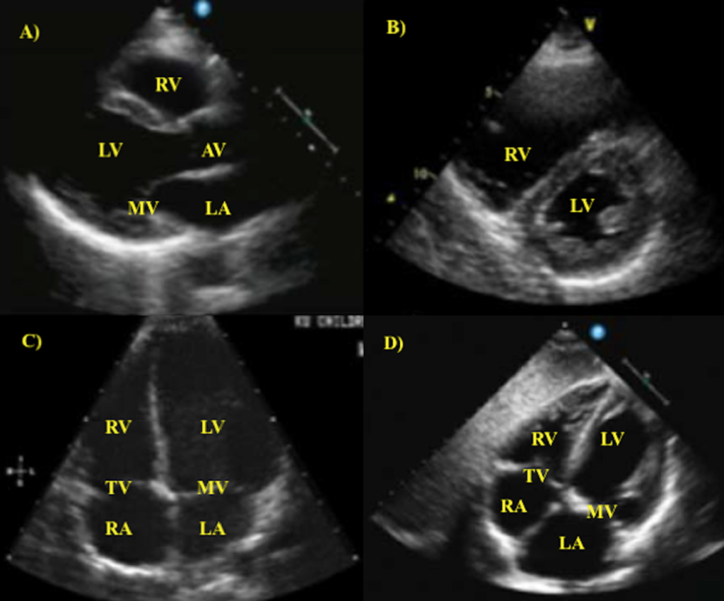 PoCUS: A Reliable Diagnostic Tool - Win Arco